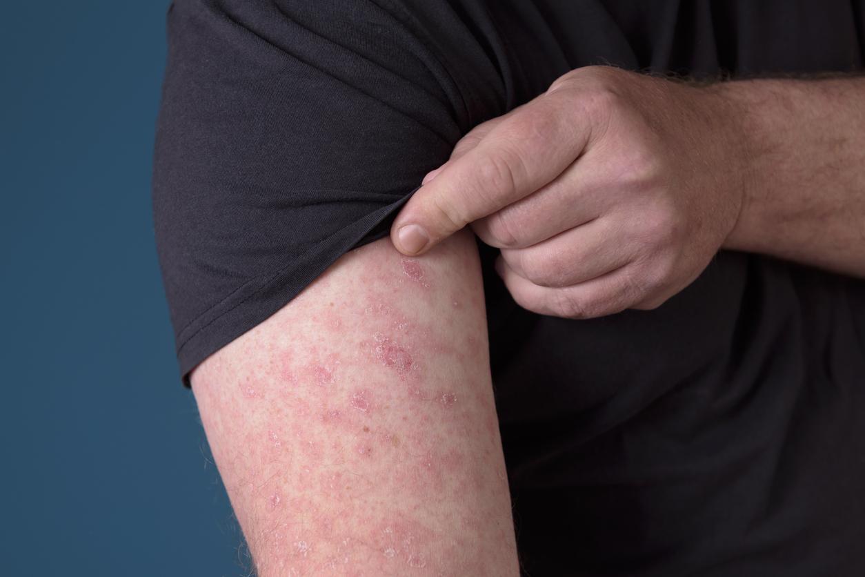 L’érysipèle, une infection à la peau à traiter | Ramsay Services